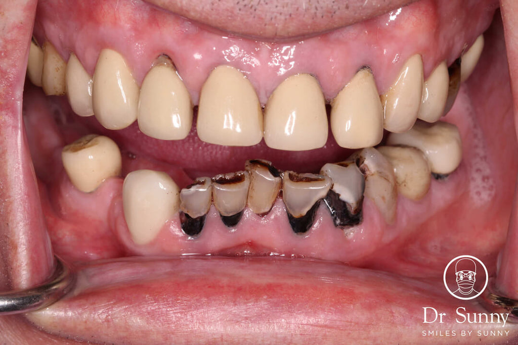 Extremely difficult lower anteriors – Greater Curve