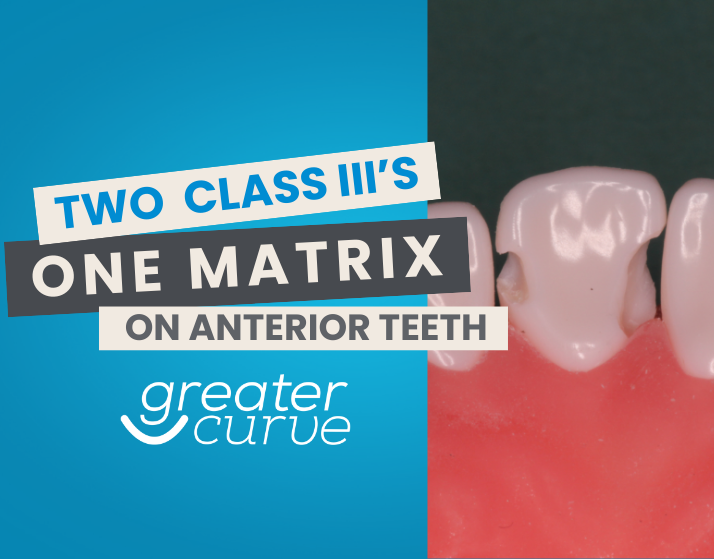 Two Class III's - One matrix band – Greater Curve