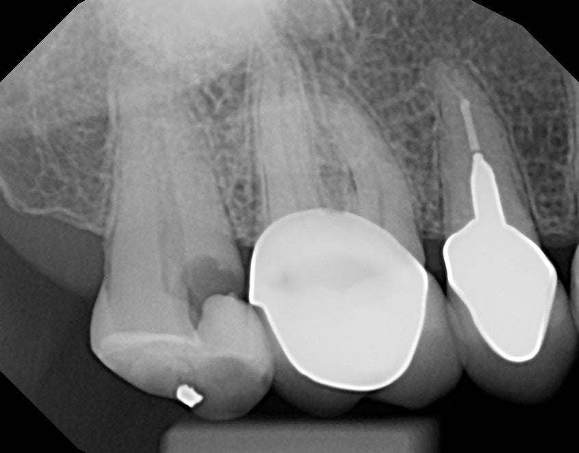 Difficult posterior restoration by Dr. Arthur R. Volker – Greater Curve