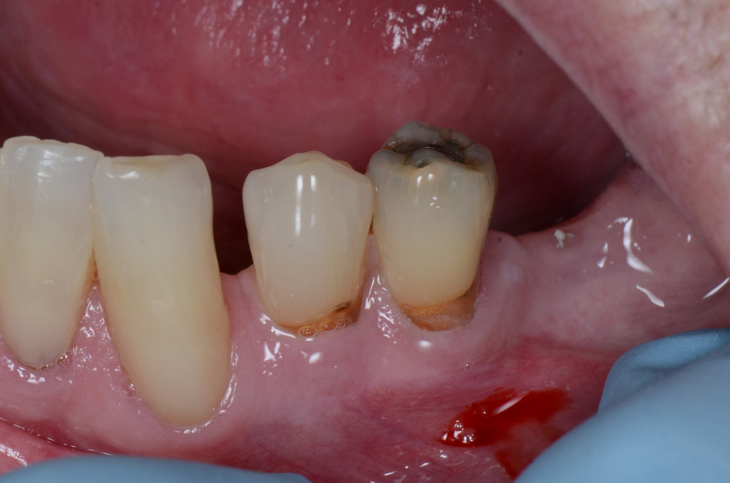 Class V on Lower Premolar by Kevin Anderson DMD – Greater Curve