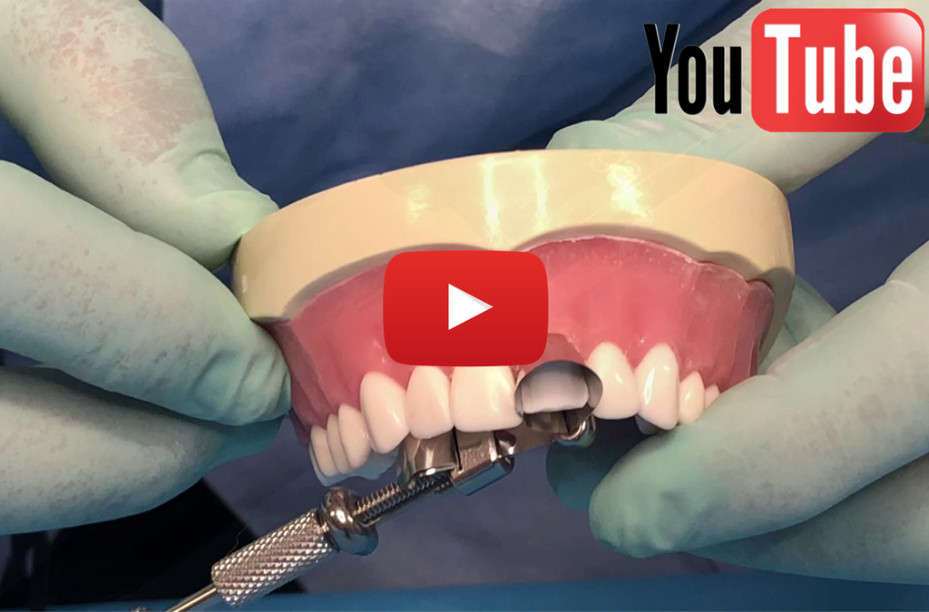 Direct Composite Veneers – Greater Curve